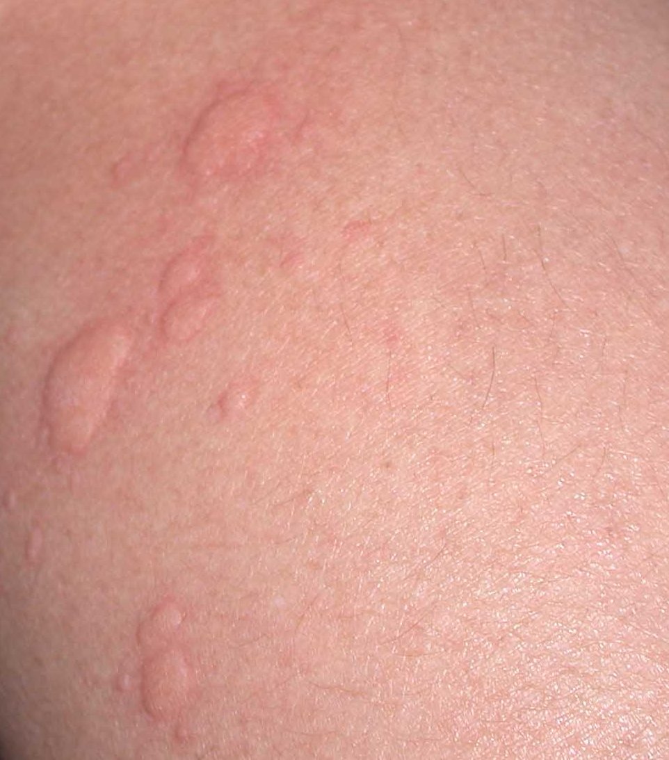 Selamat malam dokter, Saya mau tanya dok.. Apakah bekam basah bisa ...