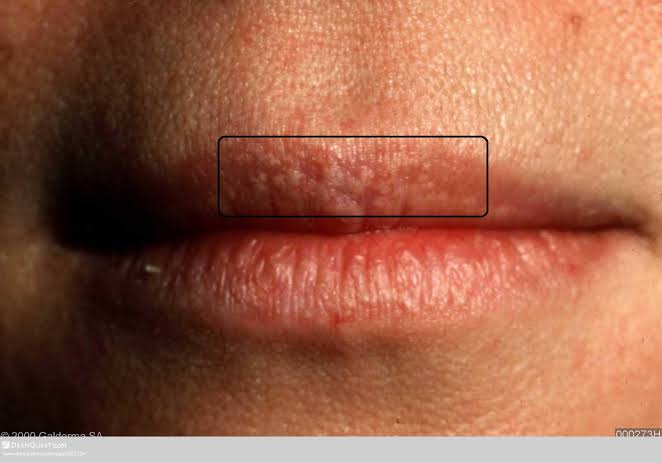 Mau tanya, kalau ada bintik-bintik putih di bibir itu kenapa ya dok ...