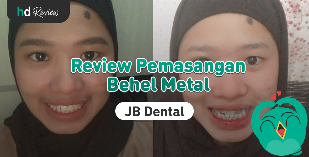 Review Pemasangan Behel Metal | HDmall